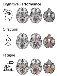 Diffusion Microstructure Imaging Illuminates Long-Lasting Br | RSNA 2023